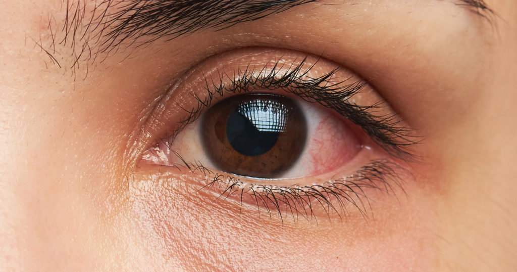 Remedios caseros para las infecciones del ojo - Salud teu